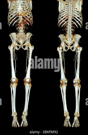 Coloured three-dimensional (3D) Angiography Computed Tomography (CT ...