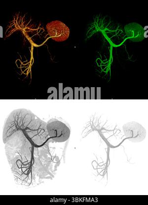 3D computed tomography (CT) angiogram scan of the heart of a 58 year ...