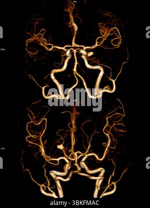 3D computed tomography (CT) angiogram scan of the heart of a 58 year ...
