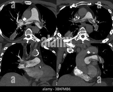 Pulmonary embolism, angiogram Stock Photo - Alamy