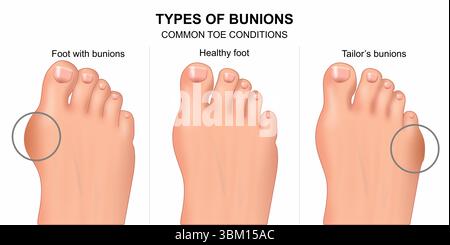 Hallux valgus, illustration. A hallux valgus, or bunion, is an abnormal ...