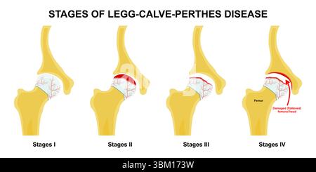 Legg-Calve-Perthes disease, illustration Stock Photo - Alamy