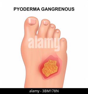 Aeromonas bacteria, illustration Stock Photo - Alamy