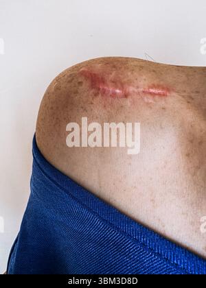 Close up of female shoulder with a scar after install a metal plate ...