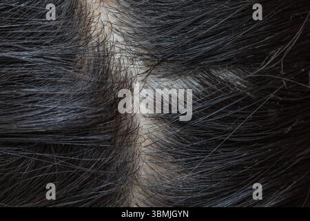 Dandruff in seborrheic dermatitis. Close-up of the scalp of a 74-year ...