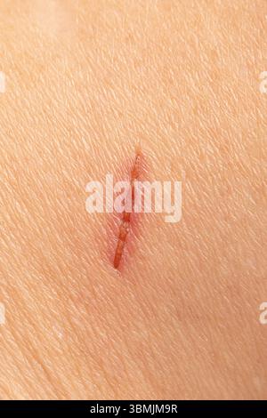 Scar tissue forming on skin, demonstrating the body's natural healing ...