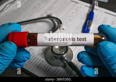 Tuberculosis. Tuberculosis disease blood test in doctor hand Stock ...