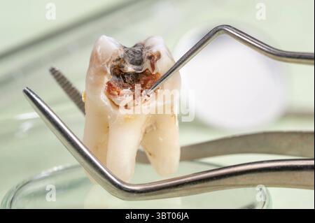 Backenzahn mit Zahnfäule und Amalgamfüllung Extrahierter Backenzahn mit ...