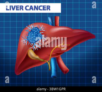 Study of liver disease, hepatology vector illustration. Cartoon tiny ...