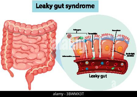 Leaky gut. Close-up of cells of a intestinal epithelium. Difference ...