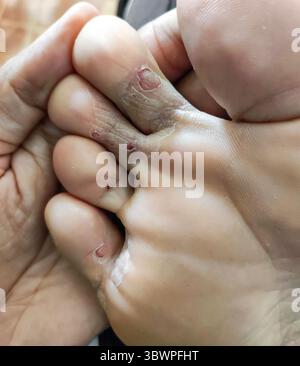 Ringworm fungal skin infection between the toes of a 7 year old child ...