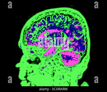 The color-enhanced MRI reveals the brain’s anatomy in striking hues. It ...
