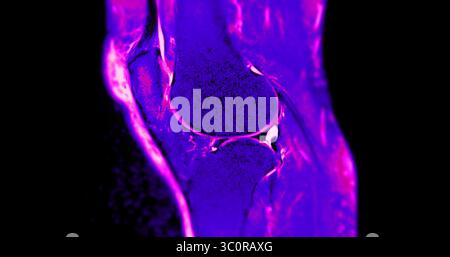 MRI knee or Magnetic resonance imaging of knee joint sagittal view for ...