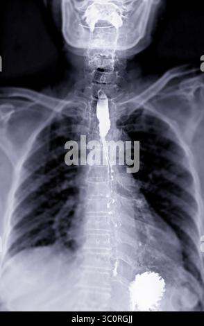 Fluoroscopic footage of a barium swallow test showing real-time ...