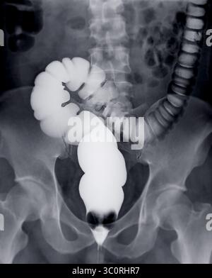 A diagnostic barium enema image showing the presence of diverticulosis ...