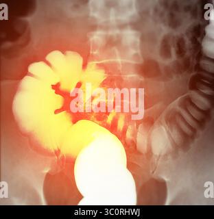 A diagnostic barium enema image showing the presence of diverticulosis ...