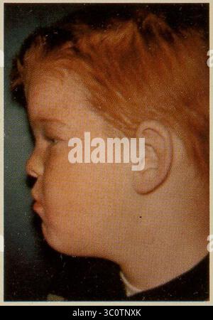 Median Cleft Face Syndrome 5 Stock Photo - Alamy