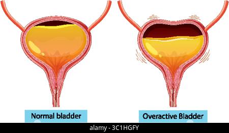 Urinary system anatomy. Incontinence biology infection uti, ureter ...
