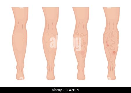VENOUS DISEASE Varicose Veins Of Human Legs Twisting And Dilation Of ...