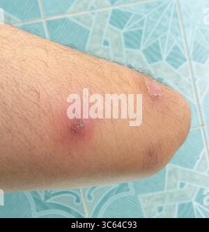 abscess or skin disease on human thigh is isolated on white background ...