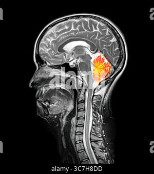 Illustration of a coloured magnetic resonance imaging (MRI) scan of the brain showing the ...