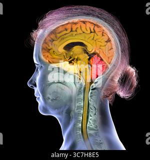 Illustration of a coloured magnetic resonance imaging (MRI) scan of the ...