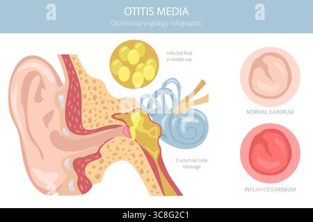 Otitis media. Infection in the middle ear. Otological disorders ...