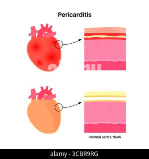 Illustration of pericarditis heart disease. This is a heart condition ...