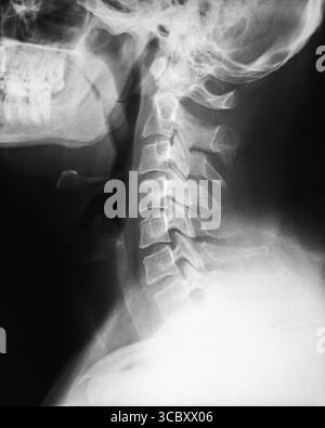 X-ray C-spine or x-ray image of Cervical spine lateral view for ...