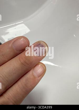 Subungual Hematoma on fingernail. Blood bruise under finger nail due to ...