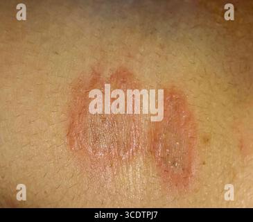 Ringworm infection, also known as Tinea corporis, on the arm of a 26 ...