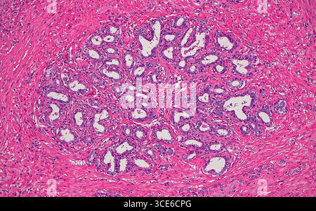 Prostate atrophy, light micrograph Stock Photo - Alamy