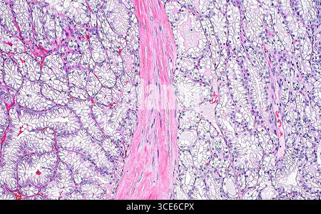 Renal cell carcinoma, light micrograph, photo under microscope Stock ...