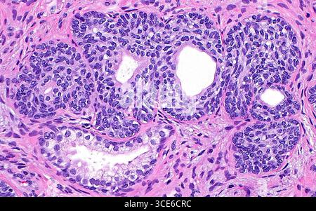 Histopathology of prostate gland hyperplasia, light micrograph, photo ...