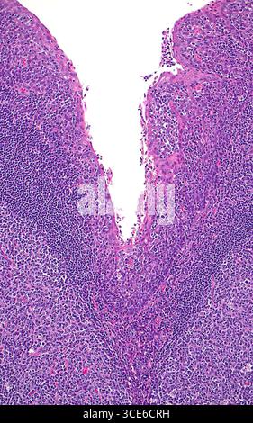 Tonsil, light micrograph Stock Photo - Alamy