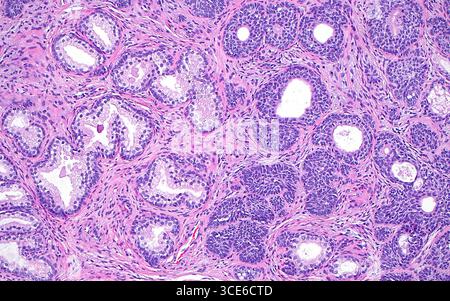 Histopathology of prostate gland hyperplasia, light micrograph, photo ...