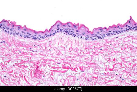 Light microscopy of skin benign growth called a seborrhoeic keratosis ...