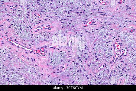 Benign prostatic hyperplasia, light micrograph. Hyperplastic nodule in ...