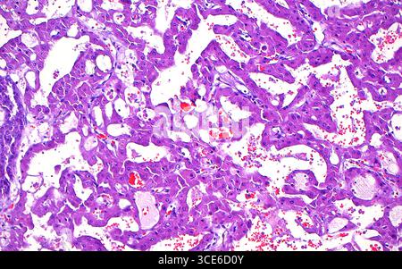Light micrograph of a human kidney affected by an advanced diabetic ...