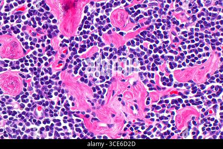 Human lymph node. Light micrograph showing metastatic cells of a ...