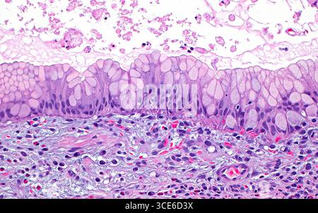 Light micrograph of a hyperplastic gastric polyp. The polypâ€™s glands ...