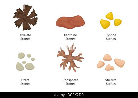 Kidney stones disease and symptoms infographic illustration Stock ...