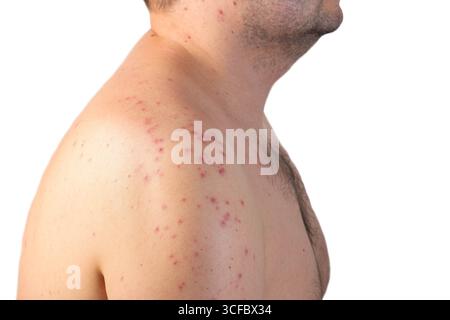 Red spots and rashes on the skin of the back and shoulders after ...