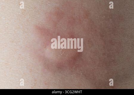 Ringworm rash. Close-up of a rash on the back of a 59-year-old male ...