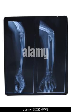 X-ray of forearm isolated on white background Stock Photo - Alamy