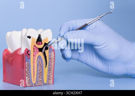 Tooth model showing advanced dental caries with cross section revealing ...