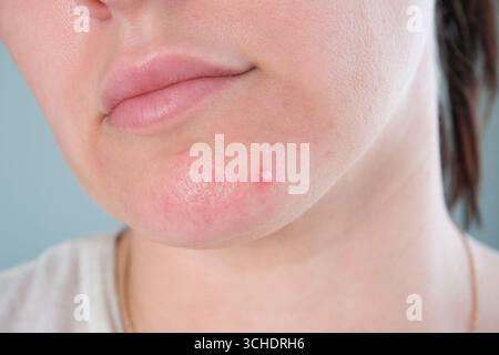 Close-up of a pimple on a woman's face. Pimple on face. Pimples and ...