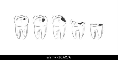 Life cycle of dental caries illustration drawing in graphic style with ...