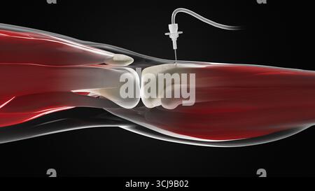 Illustration of intraosseous infusion. The procedure involves the ...