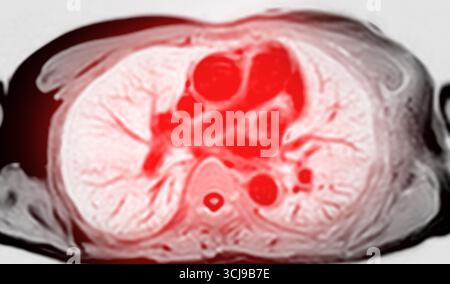 MRI heart stress test revealing detailed cardiac function under ...